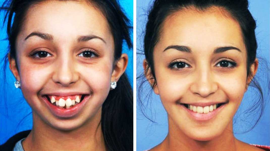 Facial Deformity Correction - Vinoda Dental